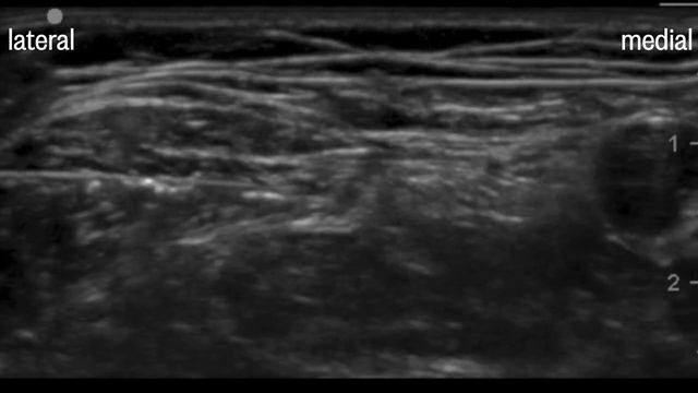 Блокада латерального кожного нерва бедра (Femoral and lateral femoral cutaneous nerve blocks)