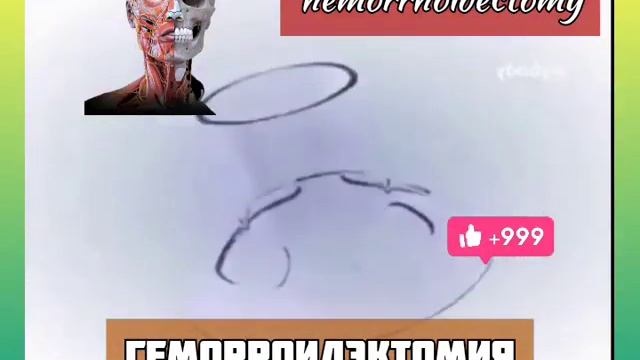 Современное лечение геморроя, Геморроидэктомия, Латексное лигирование..mp4