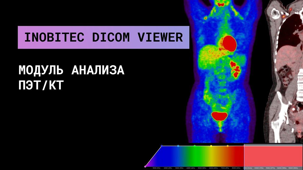 Анализ ПЭТ/КТ в Инобитек DICOM-Просмотрщике, редакция Pro