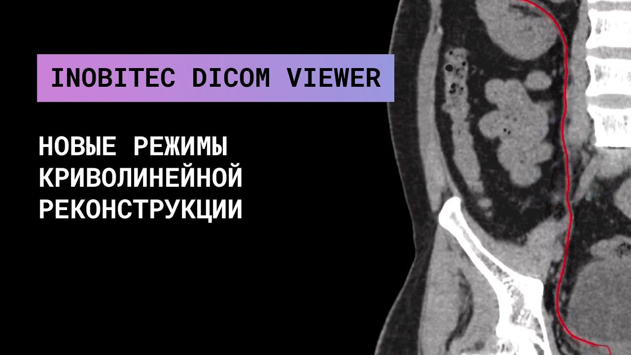 Новые режимы криволинейной реконструкции в Инобитек DICOM-Просмотрщике редакции Pro