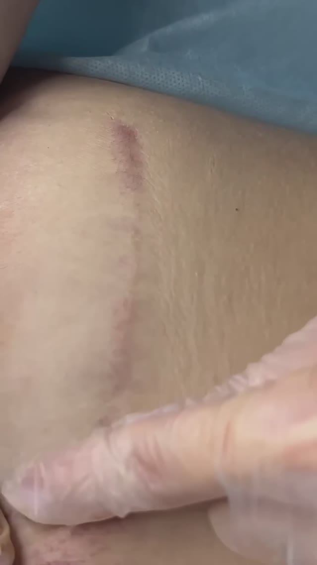 УБРАЛИ ШРАМЫ ПОСЛЕ УВЕЛИЧЕНИЯ ГРУДИ / КАМУФЛЯЖ ШРАМОВ