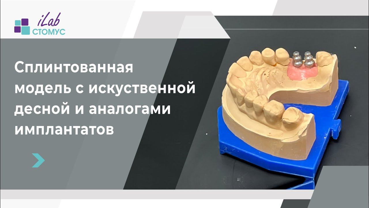 Изготовление модели с аналогами имплантата и искусственной десной.