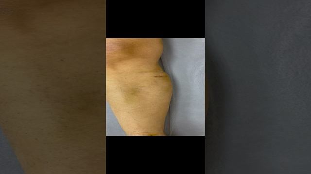 Лечение варикоза. Операция. 12-е сутки после операции. Удаление швов. Флеболог. Флеболог Москва