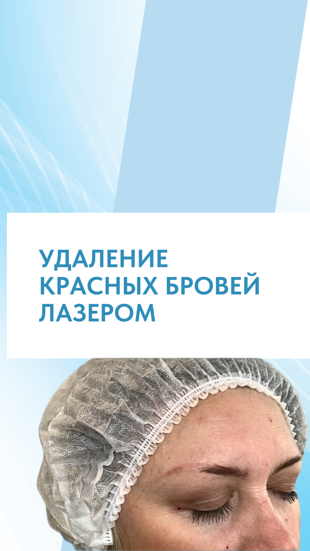 УДАЛЕНИЕ КРАСНЫХ БРОВЕЙ | БЫСТРО И НЕ БОЛЬНО 🙌🏼