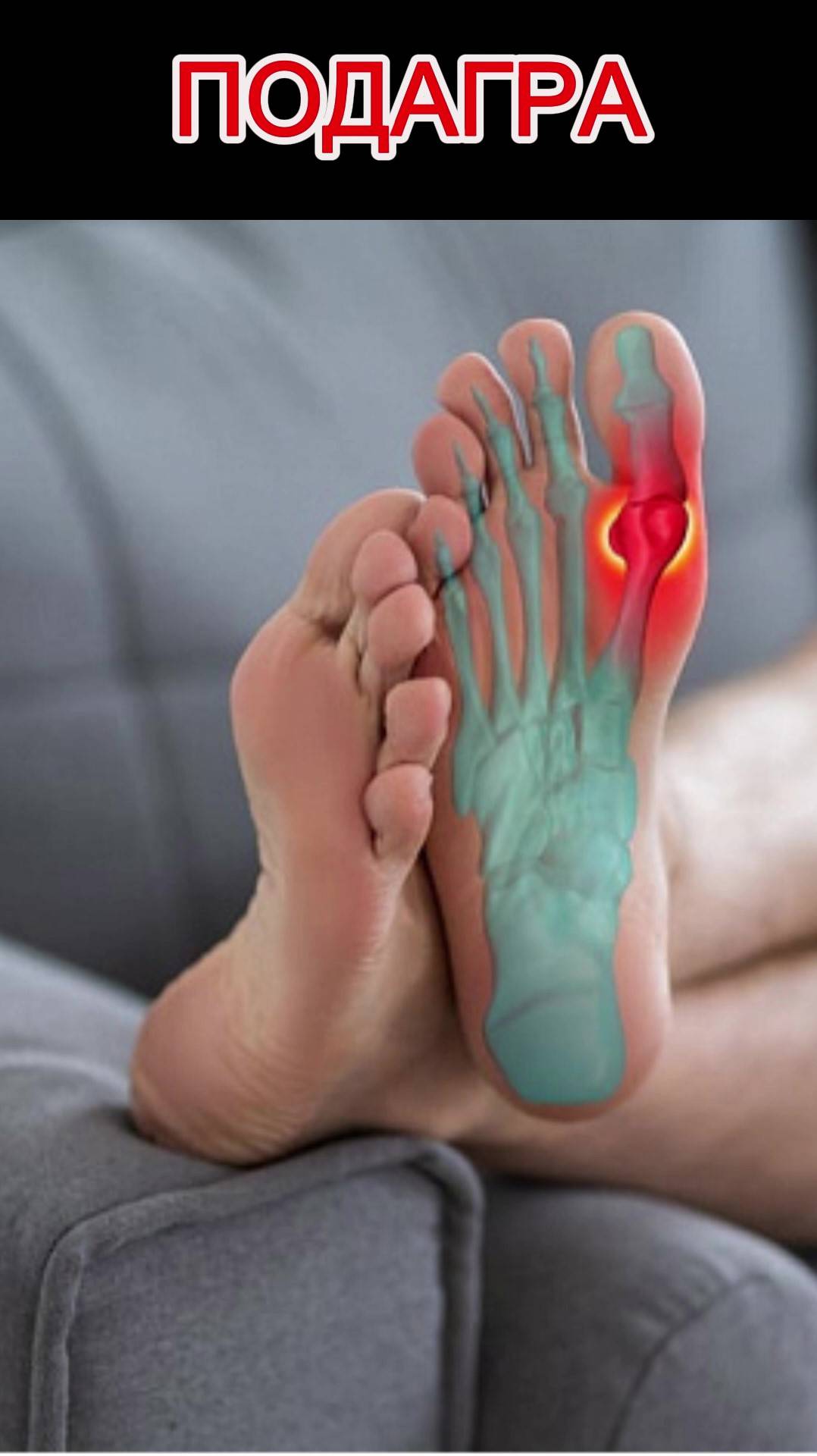 Подагра.