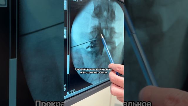 Боль в спине отдаёт в ногу. Что делать – рассказывает невролог Смирнов А. С.