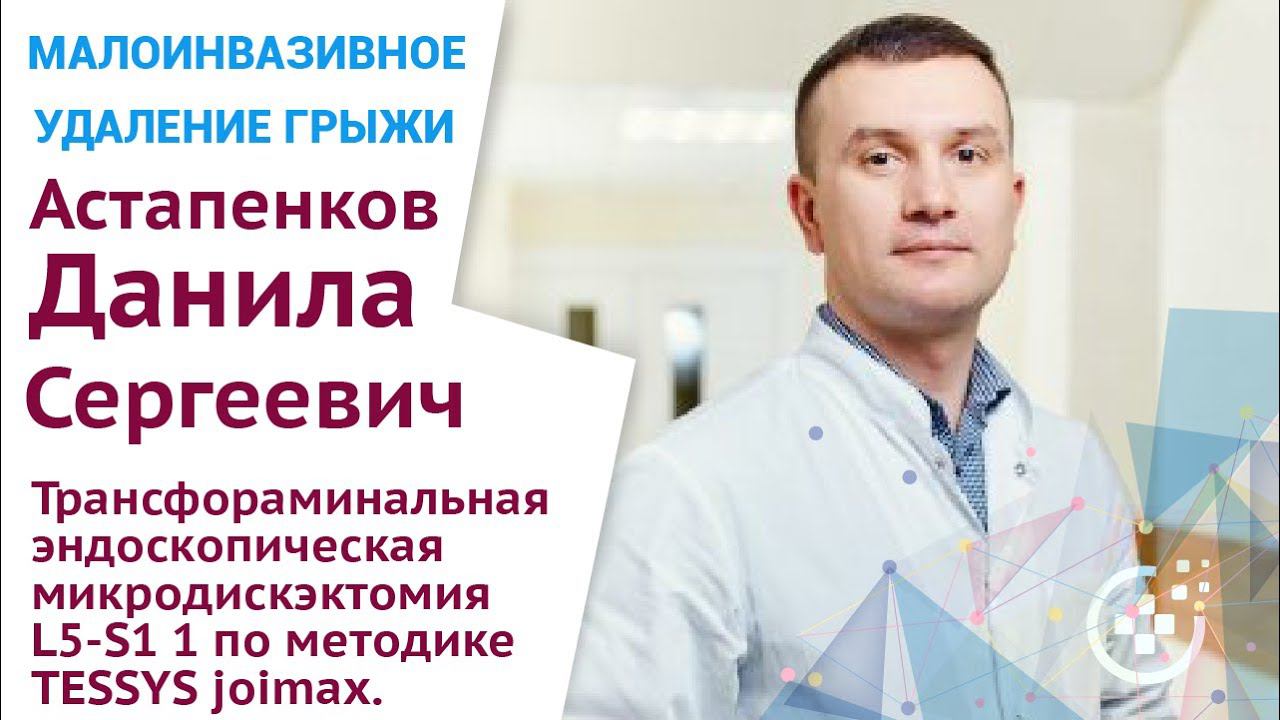 Трансфораминальная эндоскопическая микродискэктомия L5 S1 1