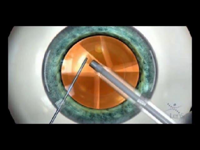 Фемтолазерное сопровождение хирургии катаракты