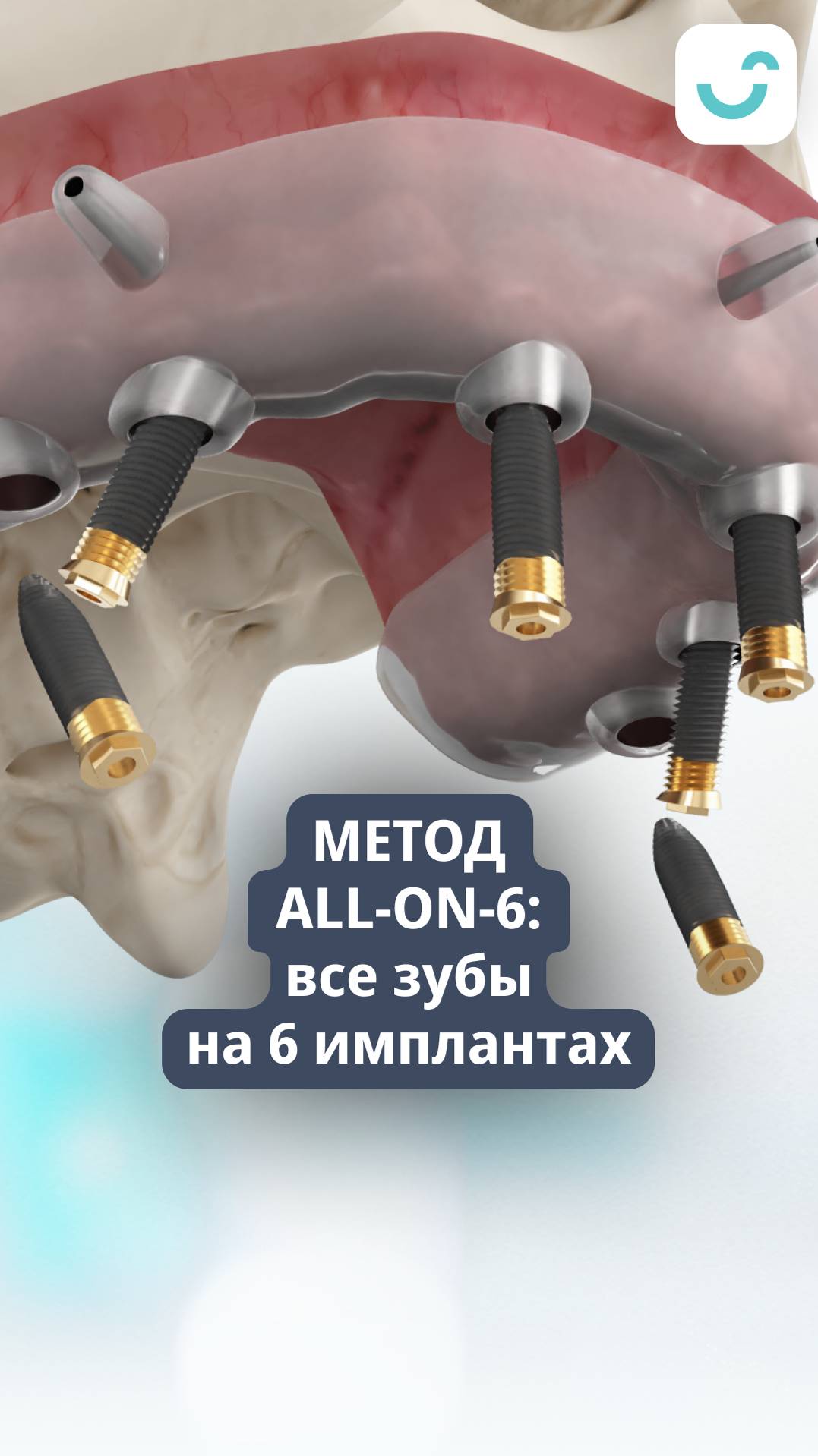 Имплантация all-on-6. К чему готовиться во время лечения?