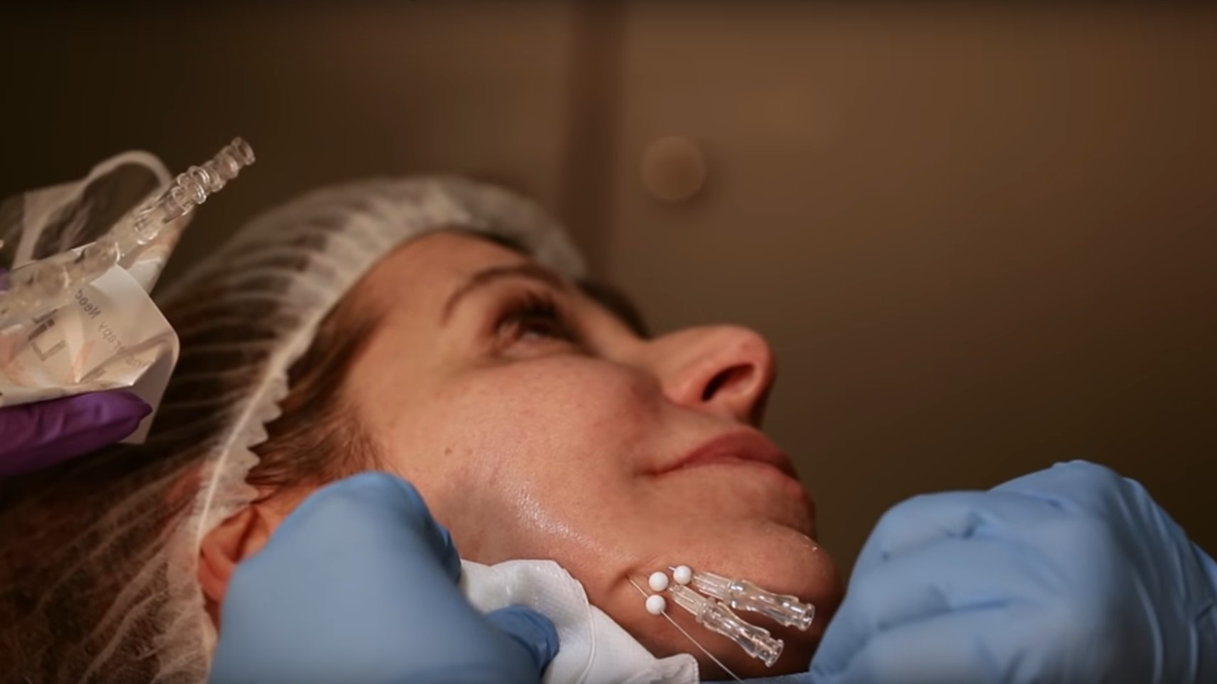 Нитевая подтяжка V-lifting