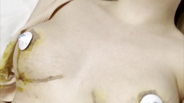 Пациентка до и после мастопексии без увеличения имплантами.