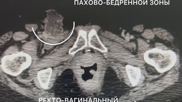 Образовавшийся ректо-вагинальный свищ и крупный конгломерат лимфоузлов бедренно-паховой зоны