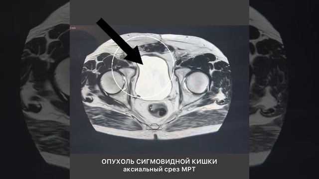Опухоль сигимовидной кишки