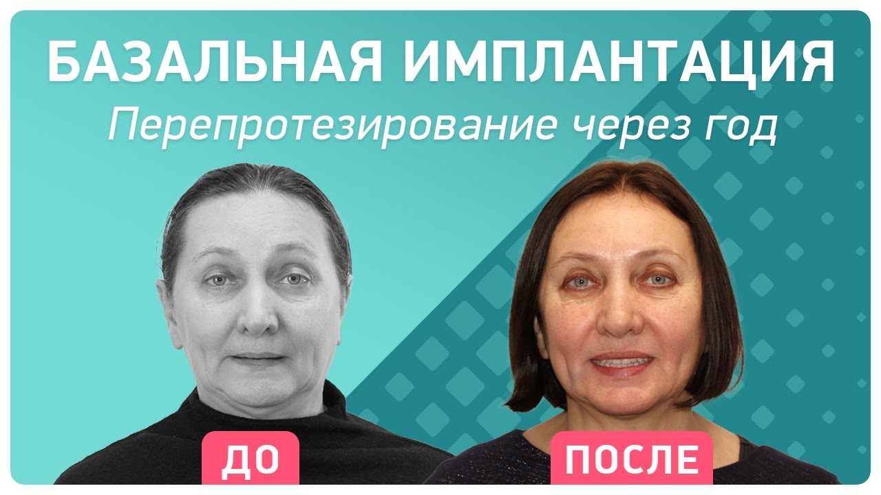 Базальная имплантация через год – ощущения после смены протеза