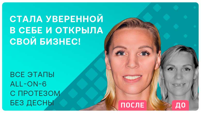 Все зубы на 6 имплантах и протез без десны: этапы цифровой имплантации