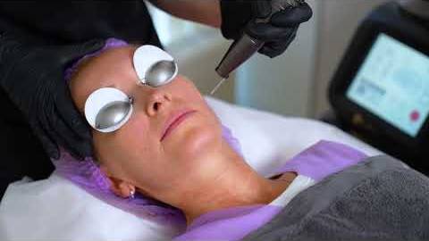 Процедура лечения пигментации на аппарате Hollywood Spectra