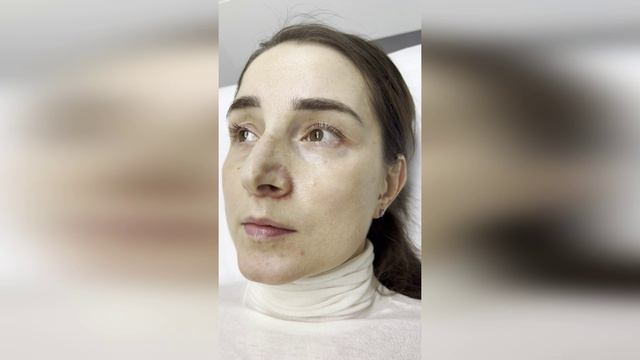 Осмотр через две недели после пластики век и губ