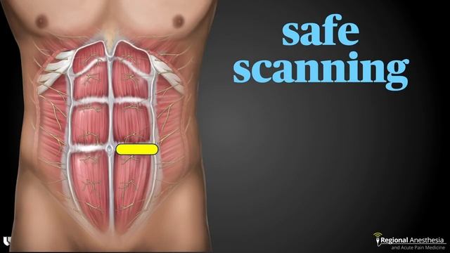 Блокада фасции прямой мышцы живота под УЗ-навигацией (Rectus Sheath Block).