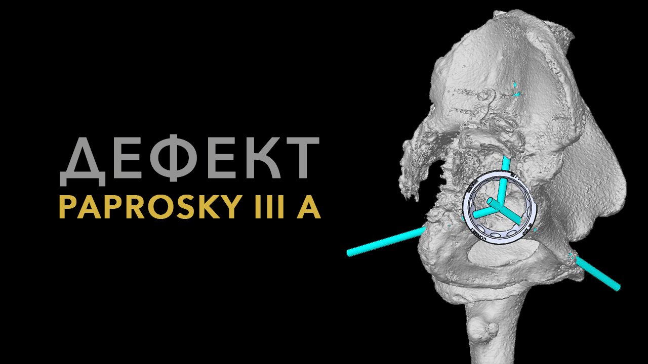 Дефект PAPROSKY III A