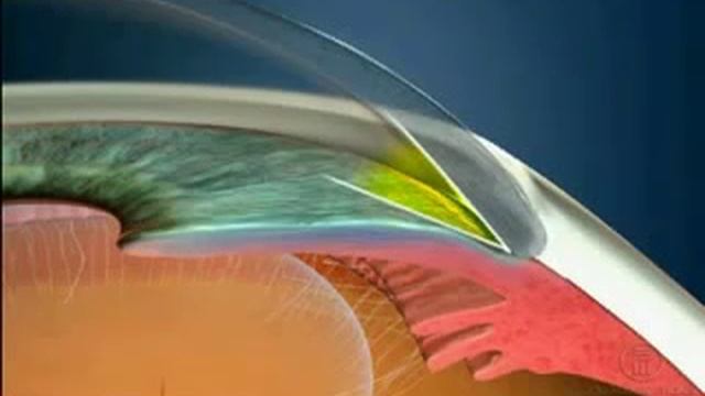 Глаукома закрытоугольная