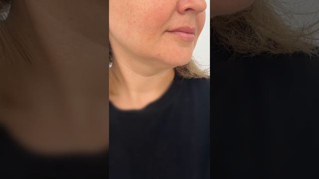 Димпл-эктомия спустя 2 недели