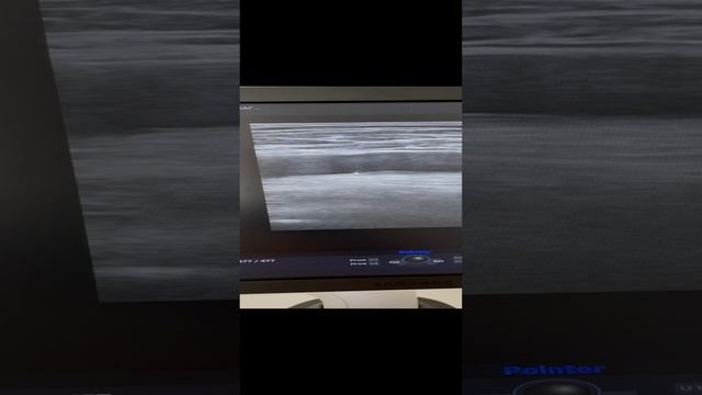 Атеросклероз артерий. Лечение атеросклероза. Диета. Статичны. Узи сосудов. Флеболог Москва