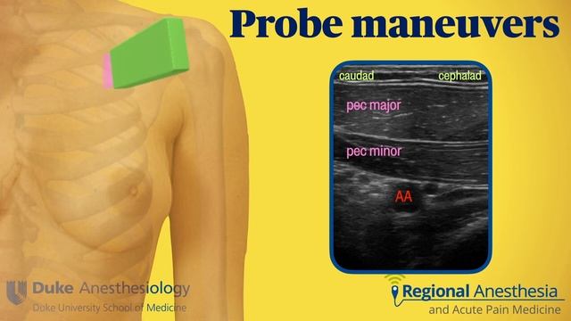 Блокады грудных нервов (PEC I & II)