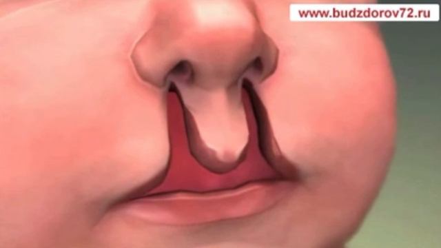 Картина Врубеля «Портрет сына». «Заячья губа» и Волчья пасть». Что это такое?