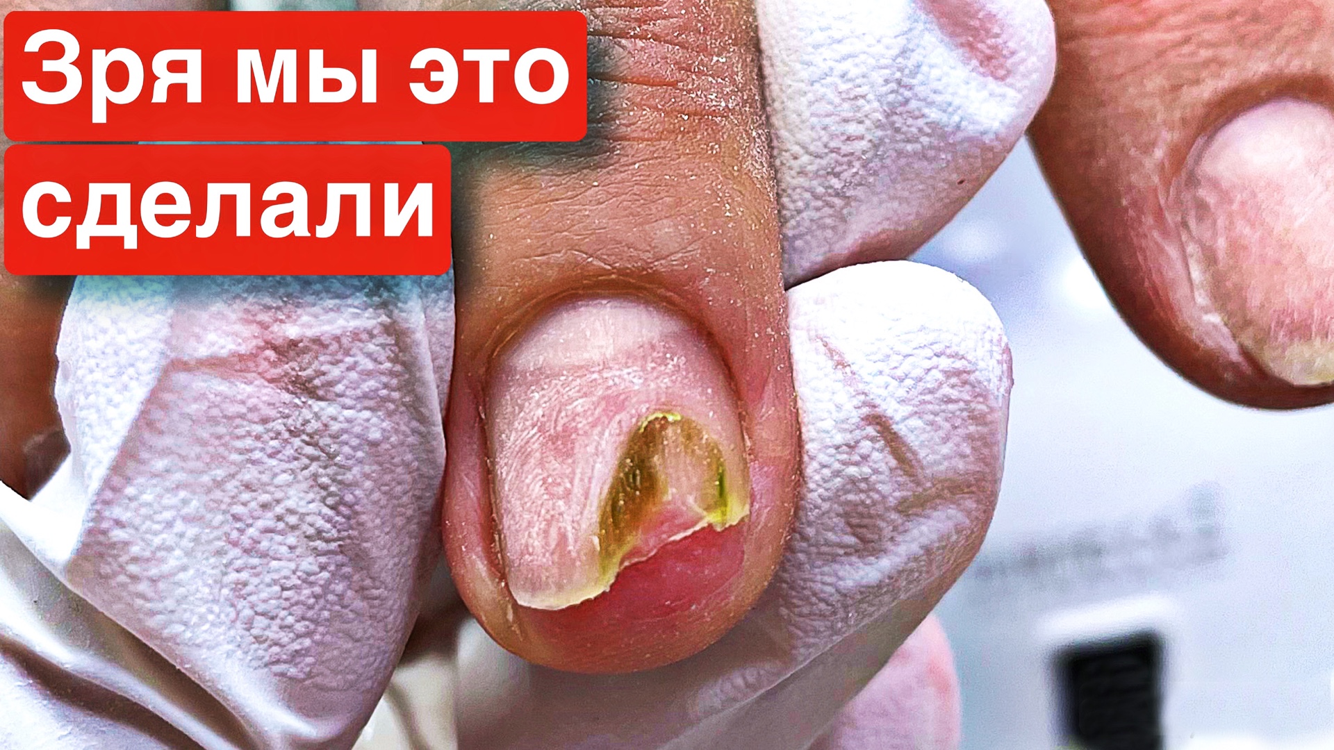 Плесень на ногтях или атравматичный онихолизис. Сложные руки.