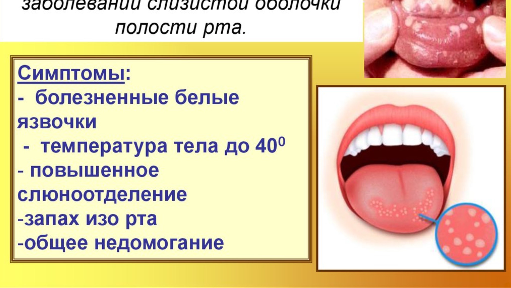 Стоматит. Что делать? Психосоматика