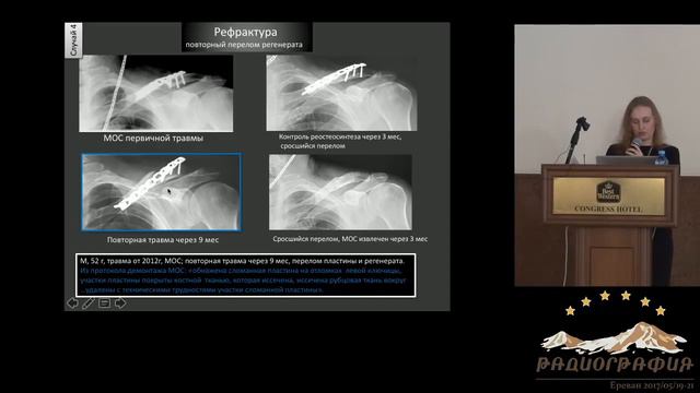 Патологические состояния при переломах. Лучевая диагностика