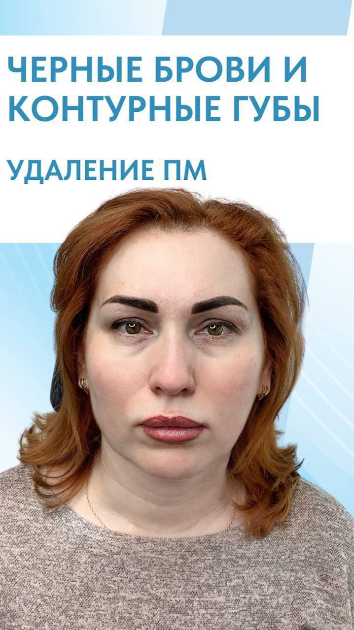 УДАЛЕНИЕ ИСПОЧЕННОГО ТАТУАЖА БРОВЕЙ И ГУБ