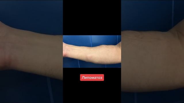 Липоматоз. Множественные липомы
