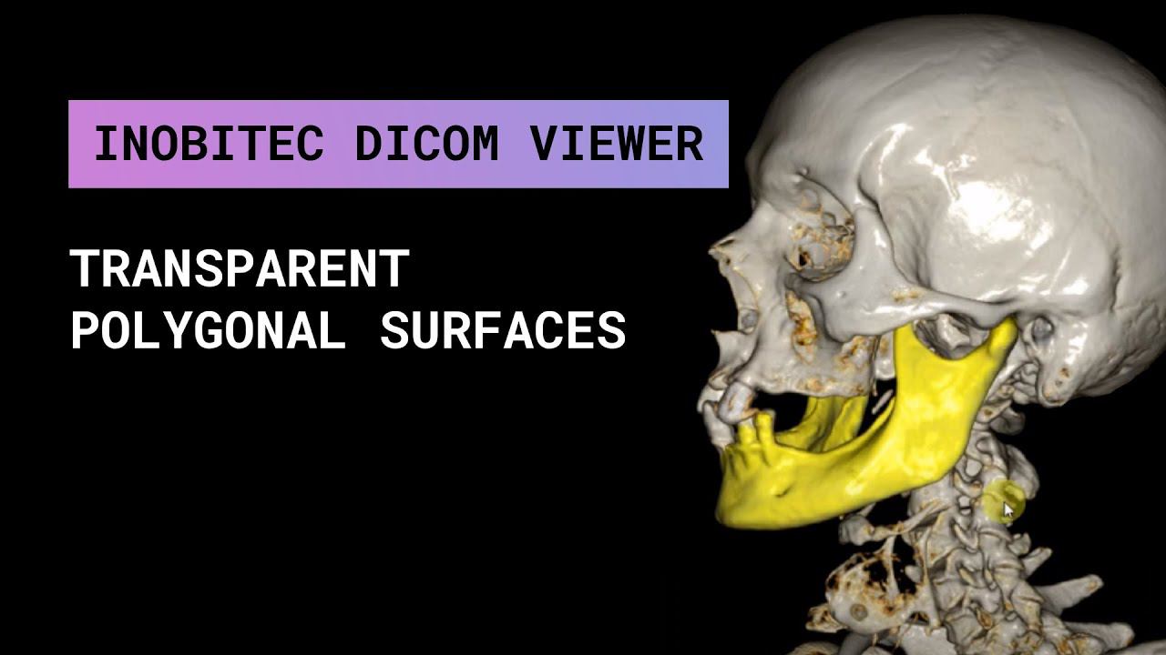Компенсация движения пациента при совмещении разных серий (челюсть)