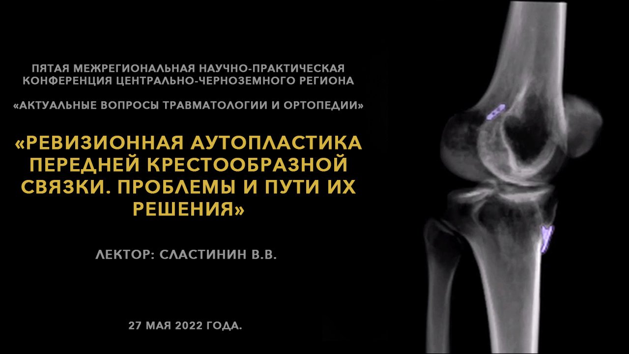 Ревизионная аутопластика передней крестообразной связки. Проблемы и пути их решения.