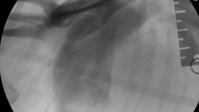 Аускультация собаки. Смешанный шум при ОАП. Слушать в наушниках.