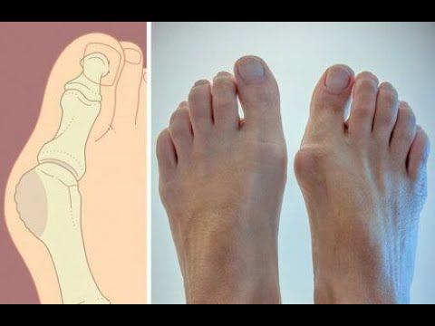 Вальгус на стопе- как с ним работать в йоге