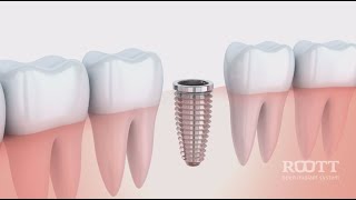 Двухэтапная установка зубных имплантов