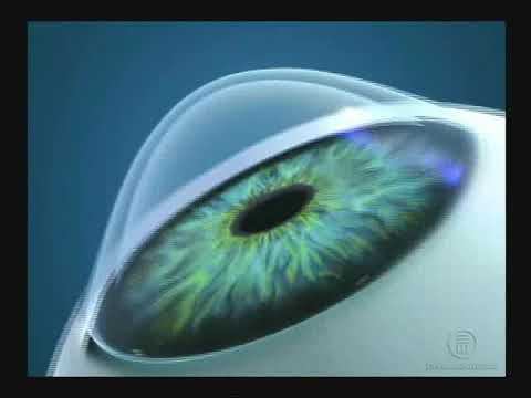 Кератоконус