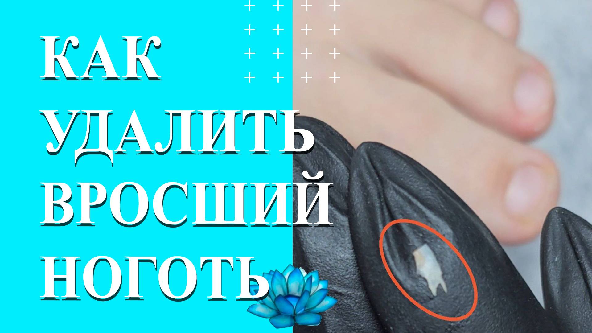 Вросший ноготь на ноге большого пальца. Удаление.