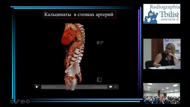 Мезентериальная ишемия СКТ-диагностика