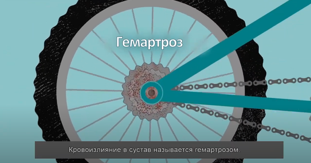 Что такое гемартроз