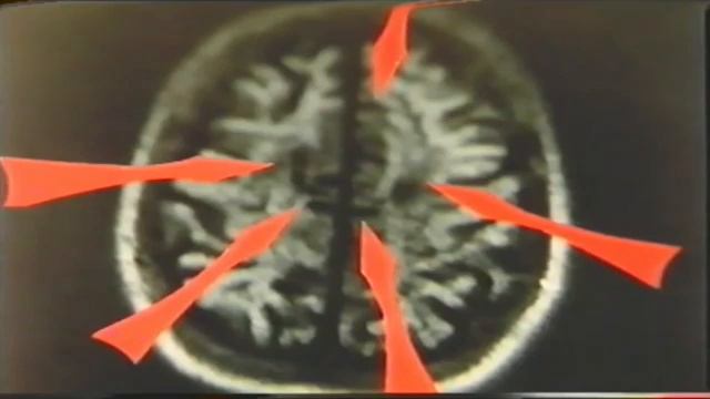 Опухоль головного мозга, метастазы в мозге или артефакты.mp4