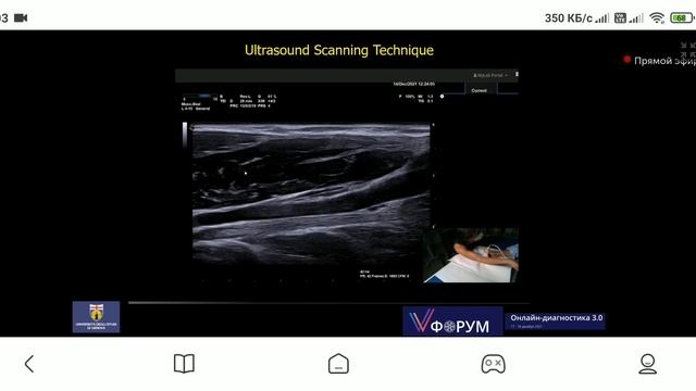 Мартиноли дистальный бицепс