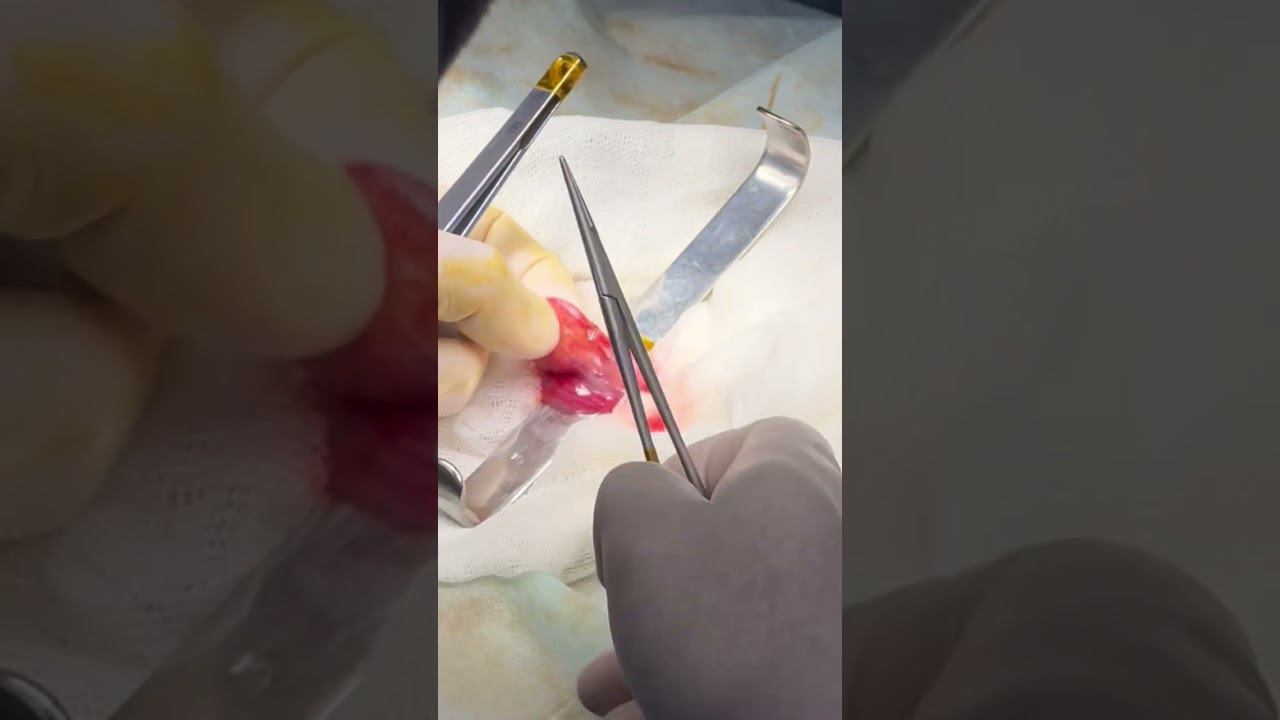 УРОЛОГИЯ. Метод Мармара - Золотой СТАНДАРТ лечения #ВАРИКОЦЕЛЕ. #бесплодие #уролог #урология