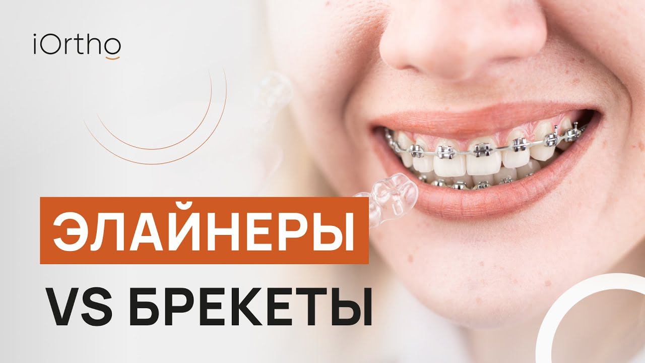 Элайнеры или брекеты: что лучше?