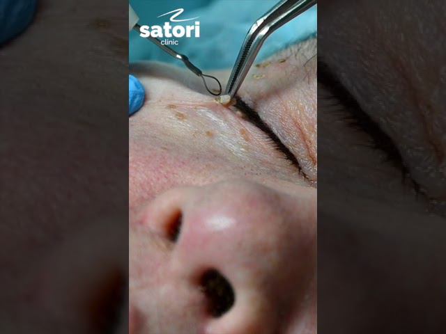 Удаление папиллом электрохирургическим методом #удалениепапиллом #хирург #папилломы