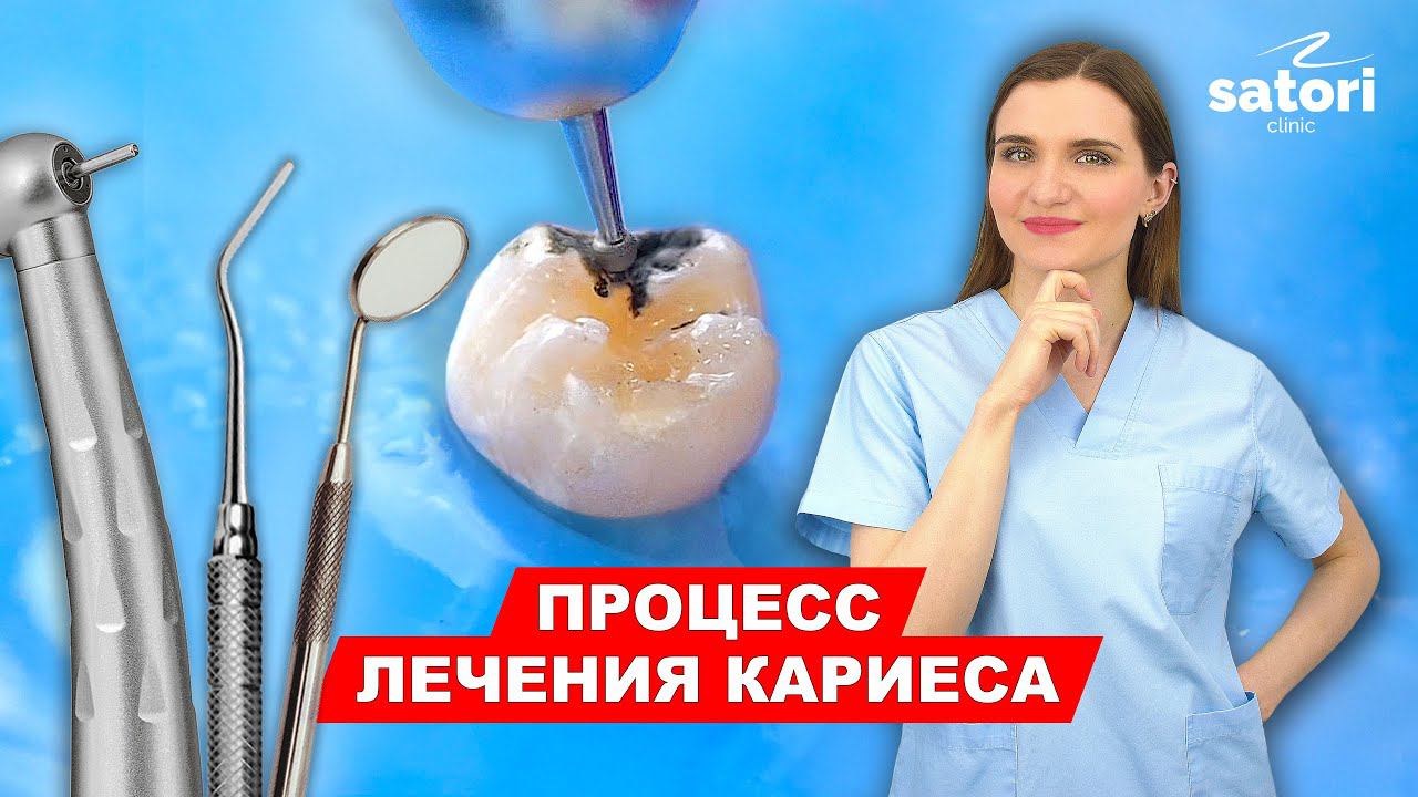Процесс лечения кариеса #стоматология #кариес #лечениезубов