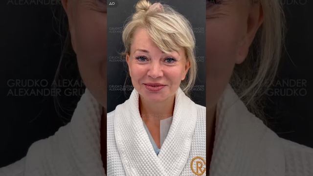 Фронтопластика: до и после, отзыв