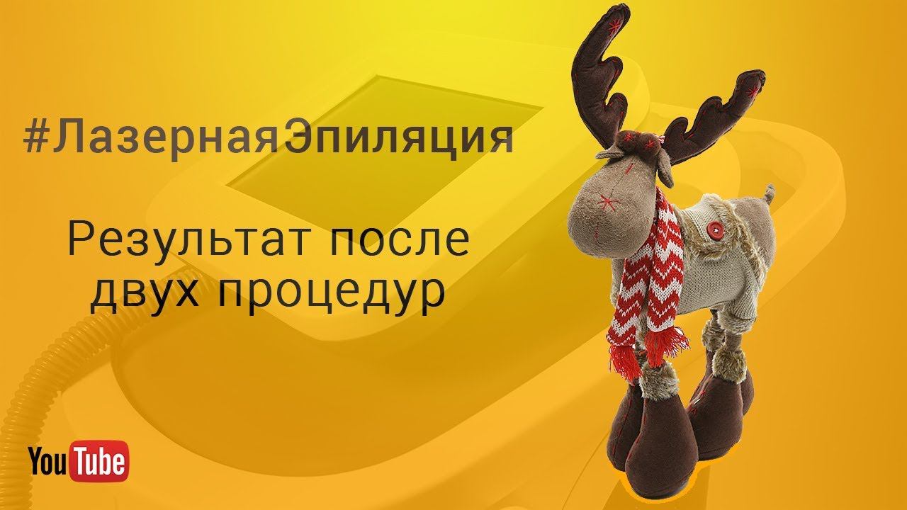 ЛАЗЕРНАЯ ЭПИЛЯЦИЯ | СЕРИЯ 3 | СОВМЕСТНЫЙ ПРОЕКТ С КЛИНИКАМИ | ОТЗЫВЫ РЕАЛЬНЫХ ДЕВУШЕК